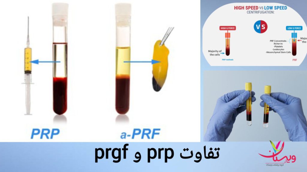 تفاوت prp و prgf | مزایا، کاربردها و نتایج هر روش در پزشکی